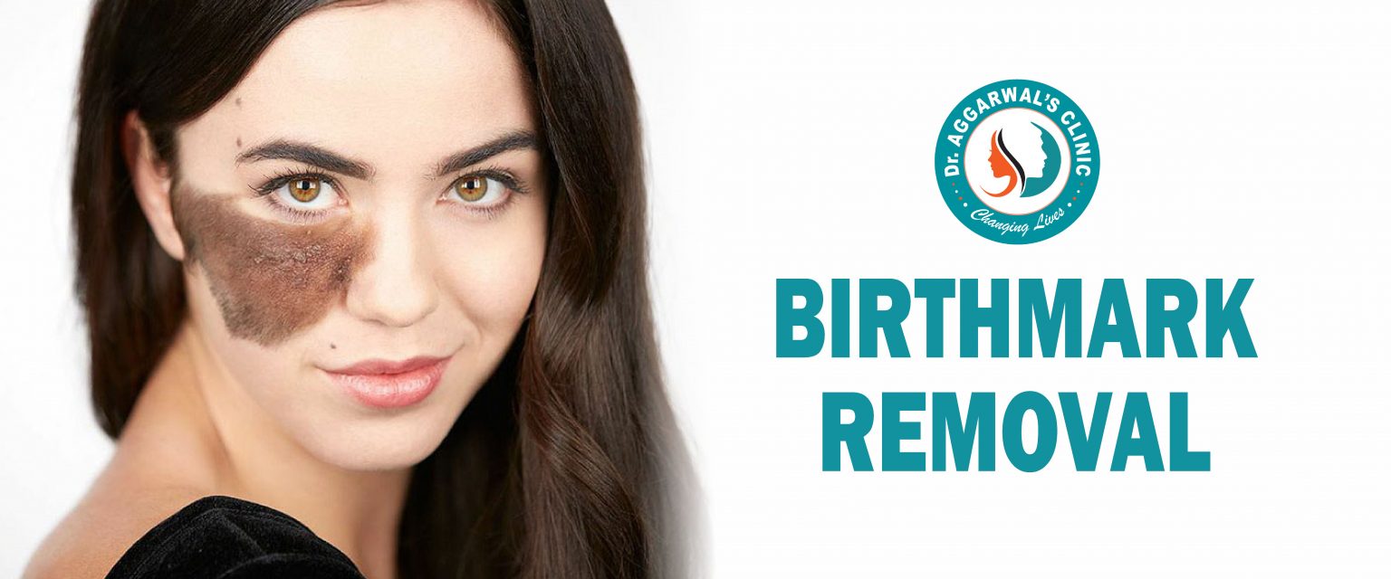 Birthmark Removal in Jodhpur - DrAggarwalsClinic